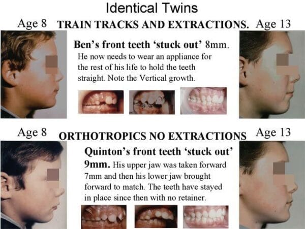 Mewing - The Secret To Beautiful Face And Straight Teeth - Jakabstore